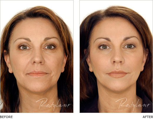 Facial Fillers (Restylane, Radiesse, Juvederm) - Tower Ear, Nose, and ...